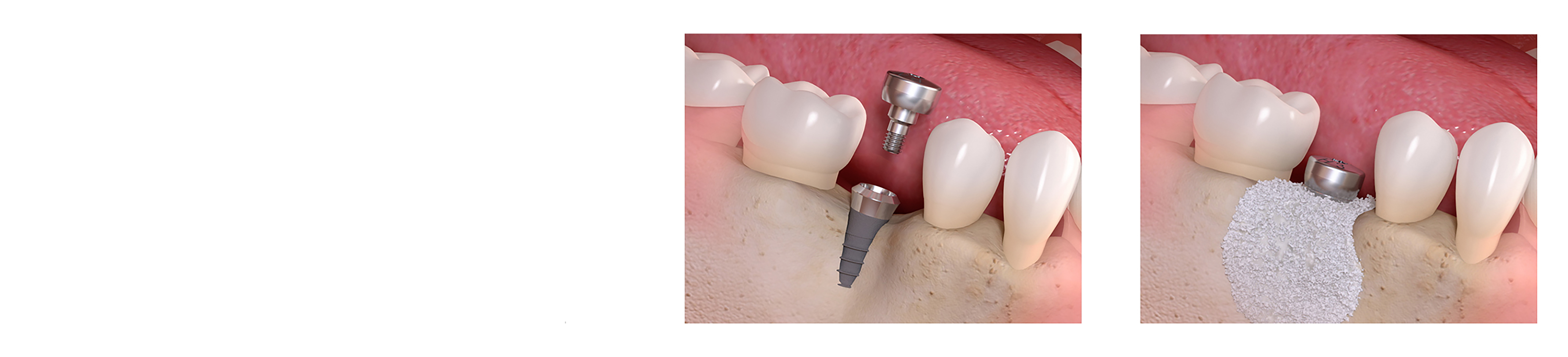 Knochenaufbau bei Implantaten